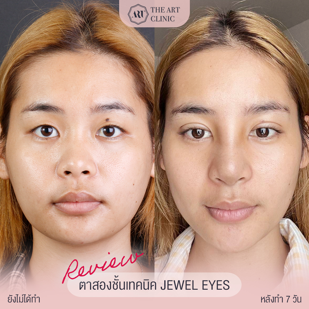 Review Eye Surgery รีวิวศัลยกรรมตา - Review The Art Clinic